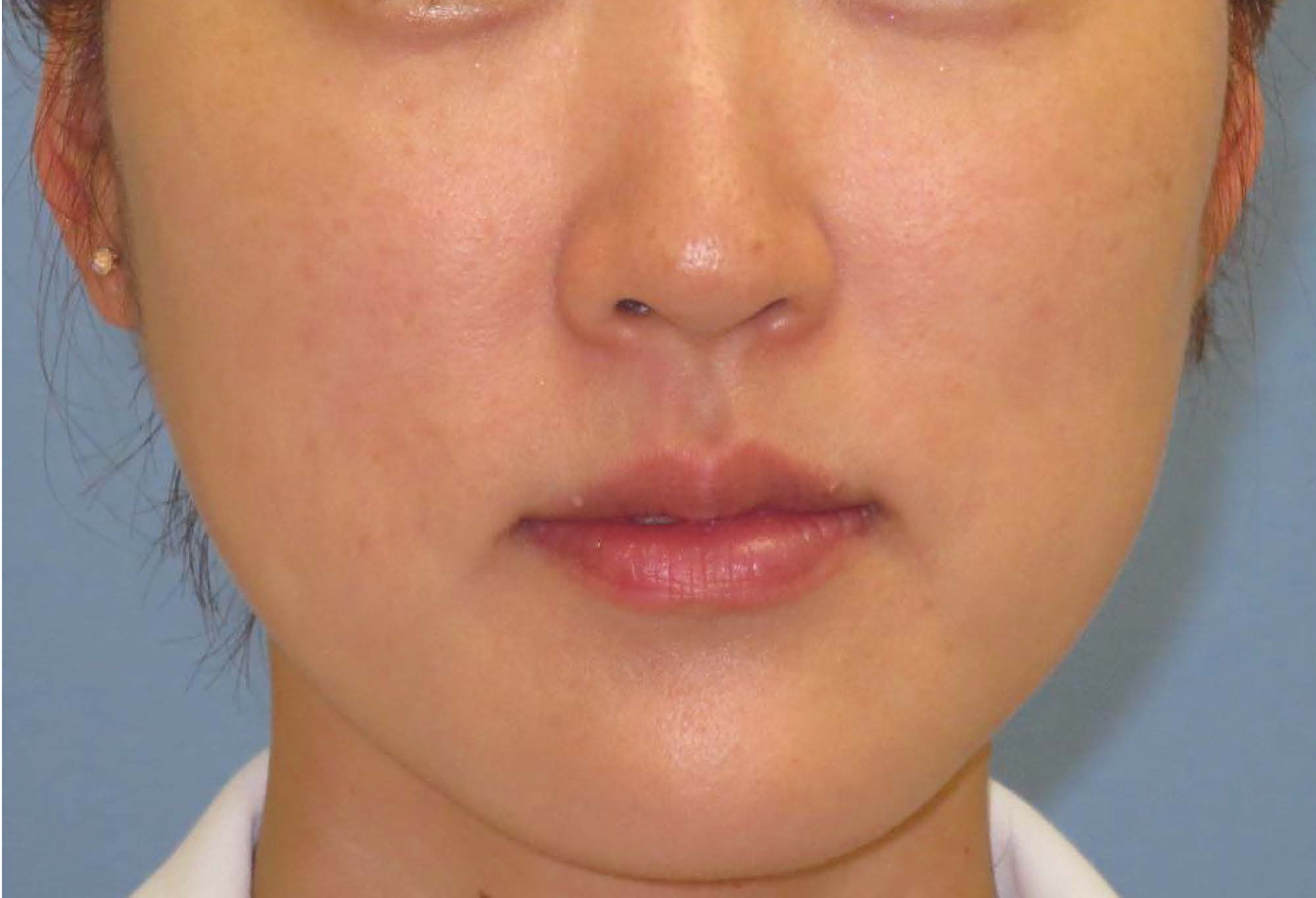 Botox injections 美容皮膚科 トキコクリニック